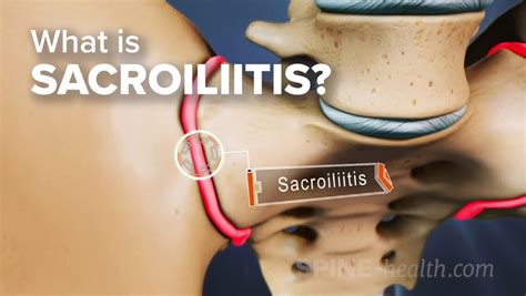 Symptoms And Diagnosis Of Sacroiliitis