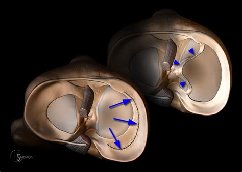 Meniscal Tear Patterns Radsource