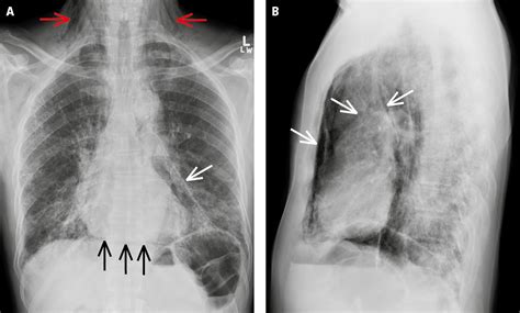 Subcutaneous Emphysema
