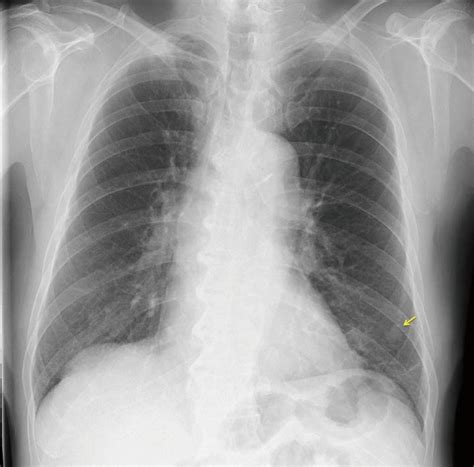 Lingular Segmentectomy And Left Lower Lobectomy Via Unique Bronchial Dissection Pmc