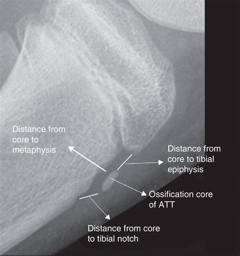 Radiographic Features Of The Development Of The Anterior Tibial Tuberosity Radiología English