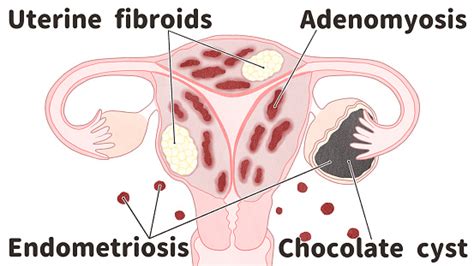 Uterine Fibroids Endometriosis And Adenomyosis Labeled Diagram Stock