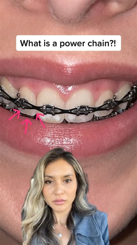 Best Braces Colors Teal Before And After Braces Braceson Bracescolors