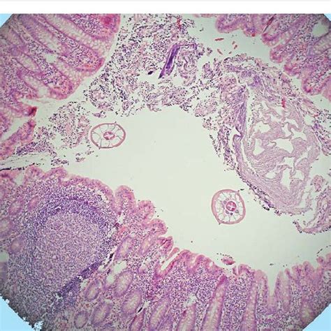 A Photograph Of The Lumen Of The Appendix Under A Larger Magnification