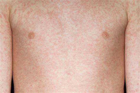 Mersey And West Lancashire Teaching Hospitals Nhs Trust Mwl Nhs Measles