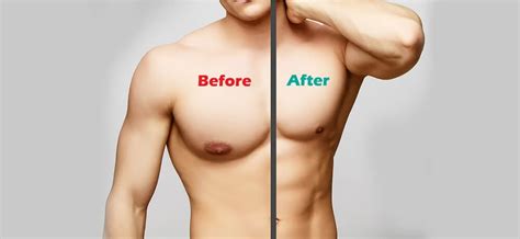 Postoperative Recovery And Scar Care What To Expect After Gynecomastia