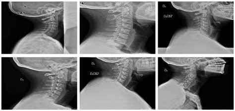 X Ray Normal Cervical Spine Anatomy 42 Off