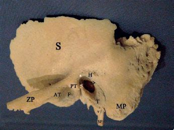 Anatomy Of The Temporal Bone Ento Key