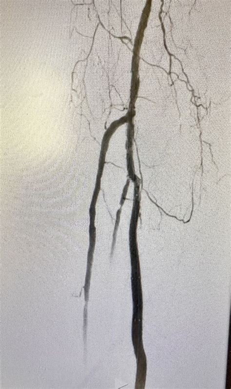 Southern Medical Group Pa Amputation Prevention Program At