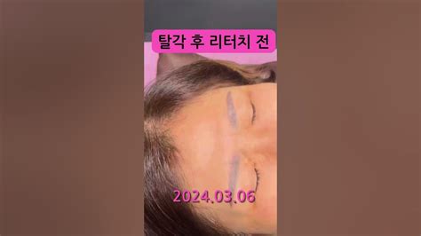 다크서클 제거 타투 후 변화 Youtube