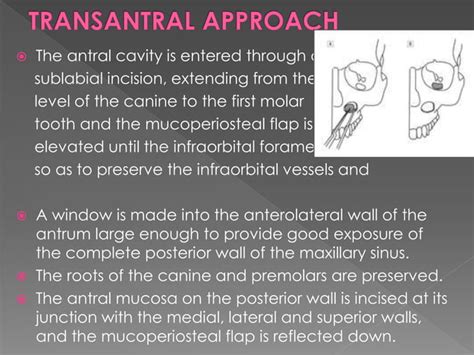 Infratemporal Fossa Approaches Pptx