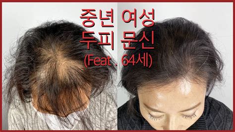 Ep06 시술리뷰 60대 중년 여성 탈모 극복 ㅣ 여성탈모 ㅣ 여자두피문신 ㅣ 흑채탈출 효도선물 추천 Youtube