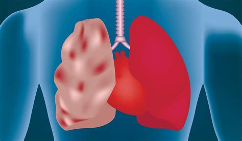 Emphysema What Is Causes Diagnosis And Symptoms