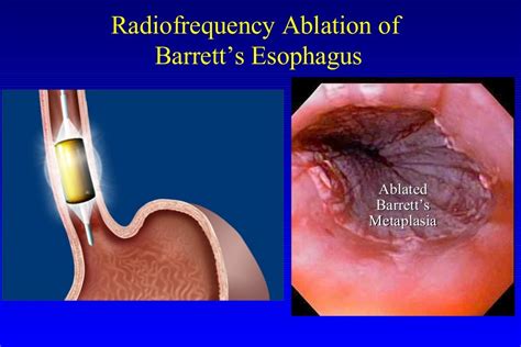 Endoscopic Biopsy Esophagus At Christian Brown Blog
