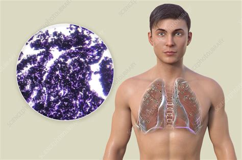 Man With Lung Silicosis Illustration And Light Micrograph Stock