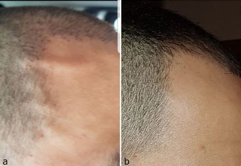 A Clinical Appearance Of The Subcutaneous Serpiginous Vessels April