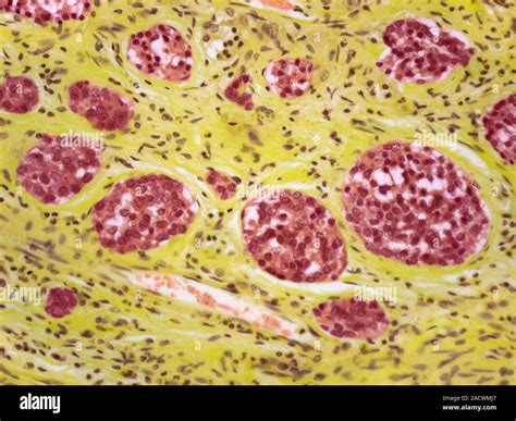 Colon Cancer Light Micrograph Of A Section Through A Carcinoid Tumour Of The Colon Large