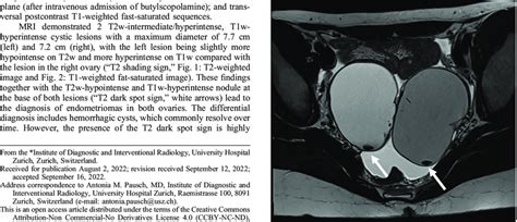 T2 Weighted Image Depicting Bilateral Intermediatehyperintense Ovarian