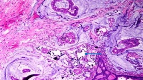 Diagnostic Dilemma Of Micropapillary Variant Of Mucinous Breast Cancer Bmj Case Reports