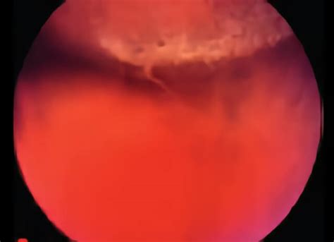 Lattice Degeneration Treatment Retinal Consultants Medical Group