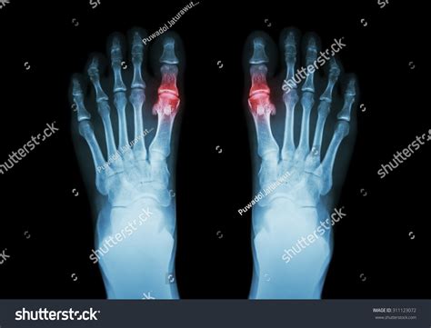 Rheumatoid Arthritis Foot X Ray