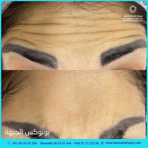 Forehead Botox The Secret To Smooth Wrinkle Free Skin