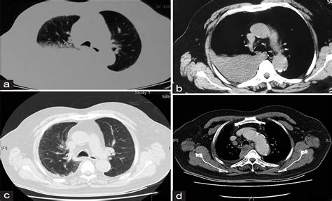 Utility Of Medical Thoracoscopy In Diagnosis And Treatment O Journal Of Cancer Research And