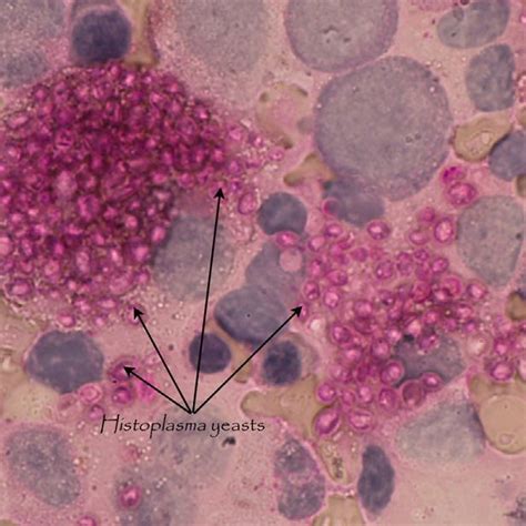 Bone Marrow Aspiration Stained By May Grünwald Giemsa Histoplasma