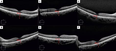 Representative Cases Of Enhanced Depth Imaging Spectral Domain Optical Download Scientific