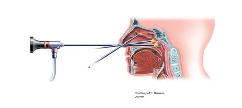What Is A Nasal Endoscopy Procedure Indications Side 44 Off