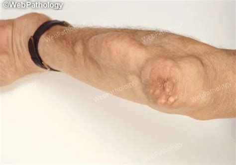 Gout Pathophysiology I