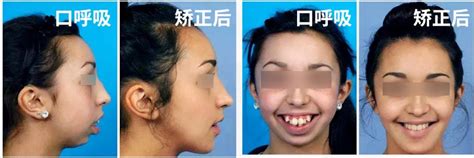 高腭弓嘴型 高腭弓和正常腭弓图片 伤感说说吧