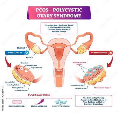 A Guide To Understanding Different Types Of Pcos Symptoms