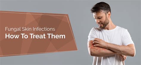 Fungal Skin Infections How To Treat Them Aakash Healthcare