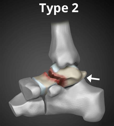 Talus Fracture Causes Types Symptoms Complications Diagnosis And Treatment
