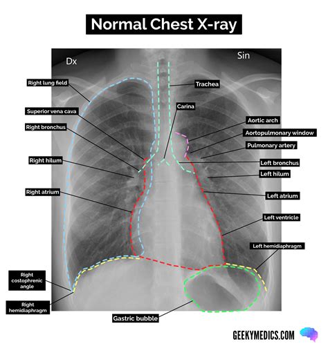 Chest X Ray Interpretation A Structured Approach Radiology Osce