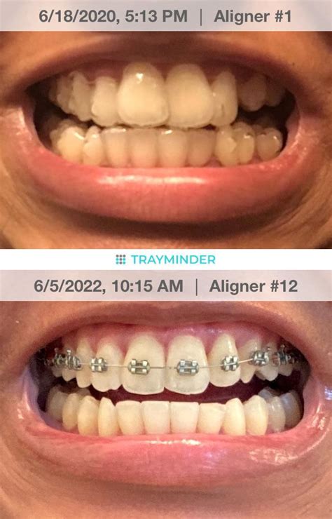 Tragus Piercing Has Growth What Do I Do Rpiercing