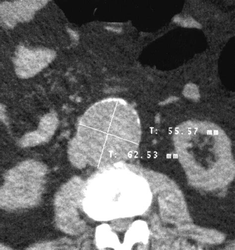 Extracolonic And Incidental Findings On Ct Colonography Virtual