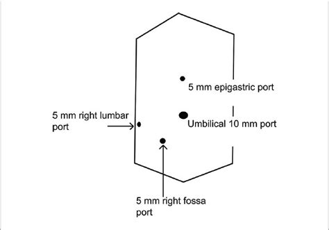 Diagrammatic Representation Of Port Placement For Laparoscopic Download Scientific Diagram