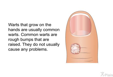 Hpv Warts