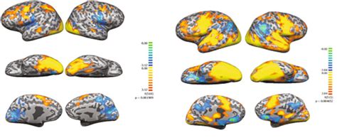 A Ffx Glm Group Activation Map For The Inner Speech Runs Qfdr