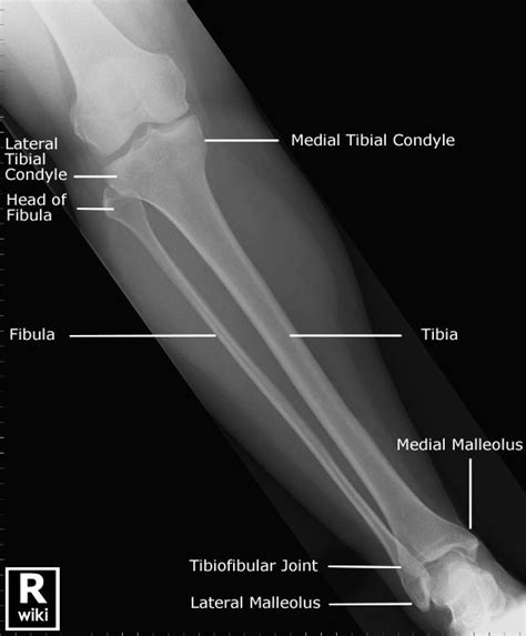 Leg Xray Labeled At Brad Rios Blog
