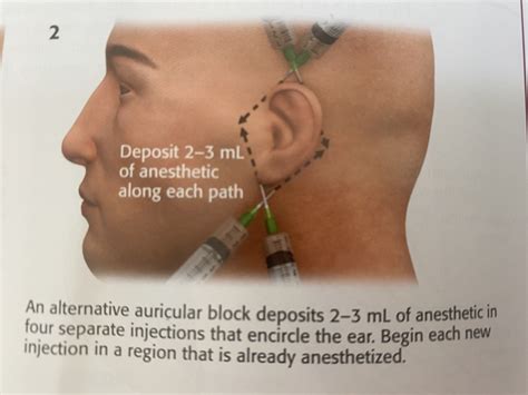 Posterior Auricular Nerve Block