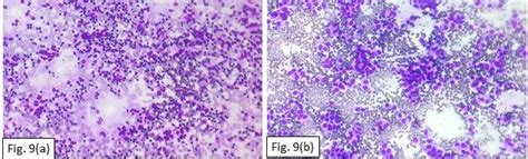 Pleomorphic Adenoma Cytology 1600x1200