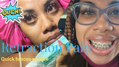 Braces Closing Gaps From Extractions At Indiana Mulquin Blog