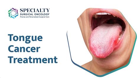 Best Tongue Cancer Treatment Hospital In Mumbai