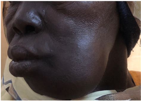 Preoperative Clinical Finding Of The Mandibular Swelling Download Scientific Diagram