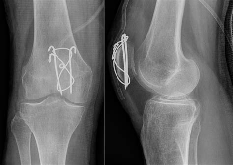 Patella Fracture Treatment Patella Bone Fracture Surgery
