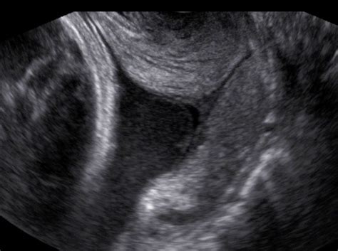 “in Asymptomatic Women With A History Of Sptb And A Short Cervix