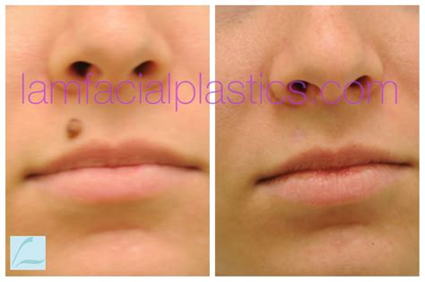 This Young Lady Had A Mole Removed From Her Upper Lip And Is Shown